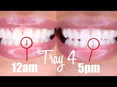 WK 9 (Clear Braces): Tray 3 Update + Tray 4 Try-on | SmileDirectClub | Kyma Monai
