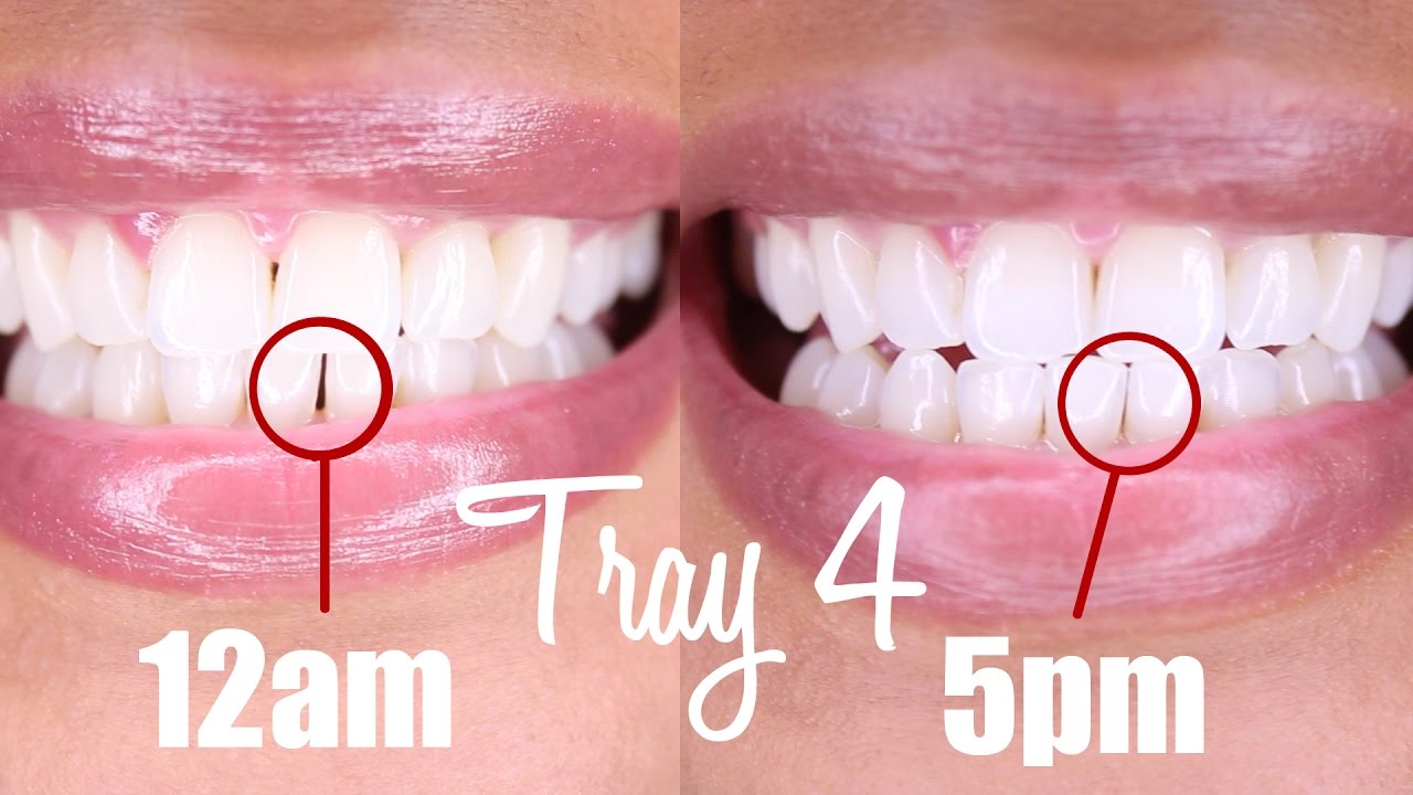 WK 9 (Clear Braces): Tray 3 Update + Tray 4 Try-on | SmileDirectClub ...
