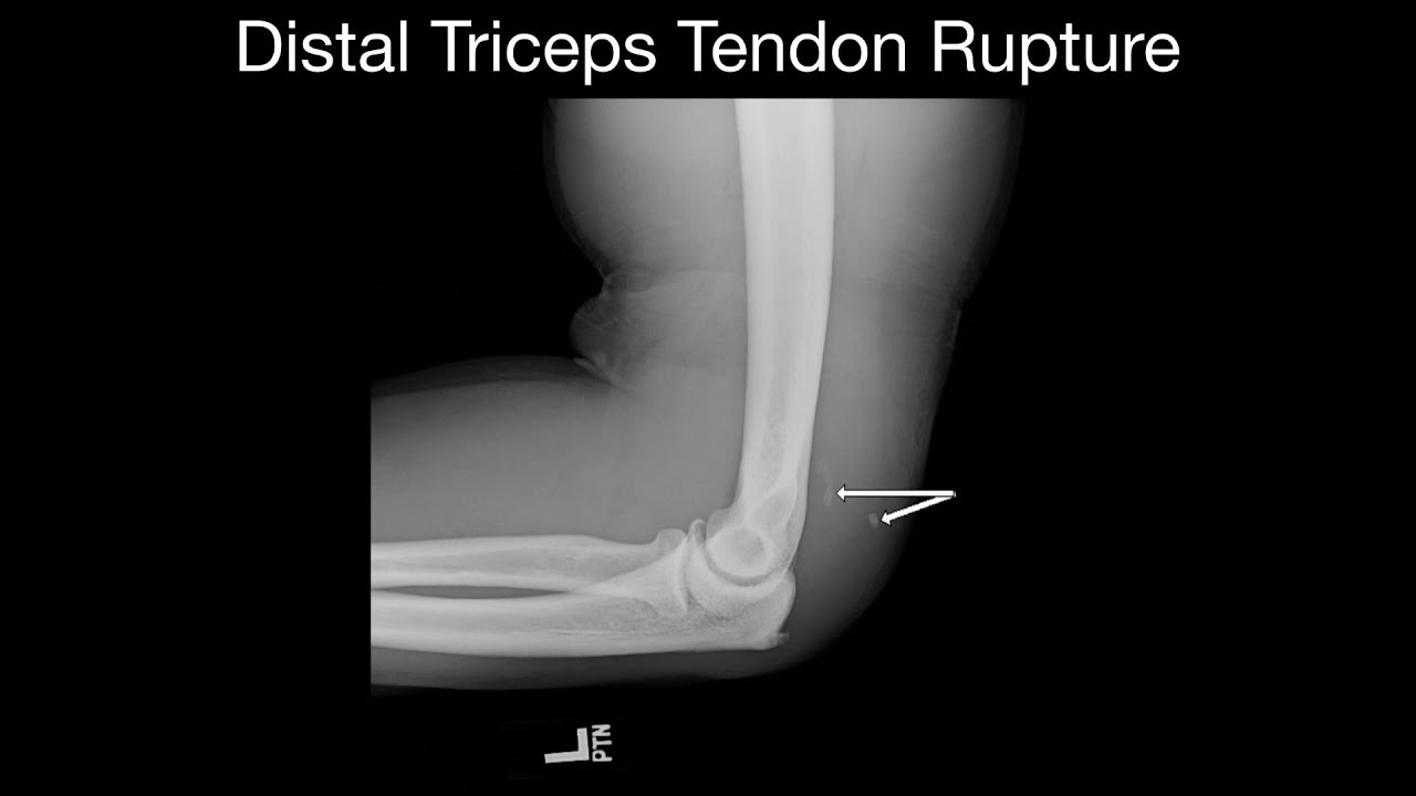 Distal Triceps Tendon Rupture - YouTube