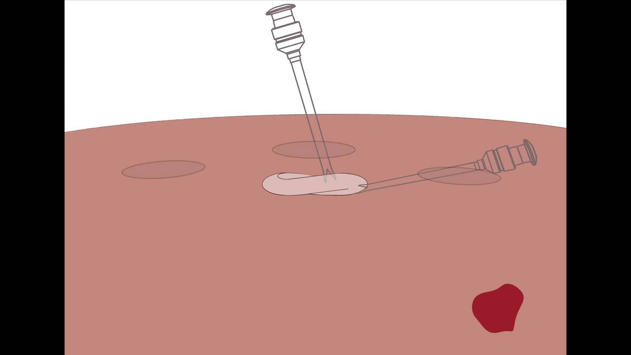 Morcellation Bag Animation - YouTube