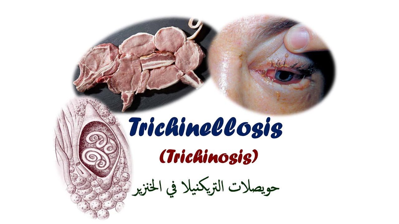 Lecture 47: Trichinellosis (Trichinosis) حويصلات التريكنيلا في الخنزير ...