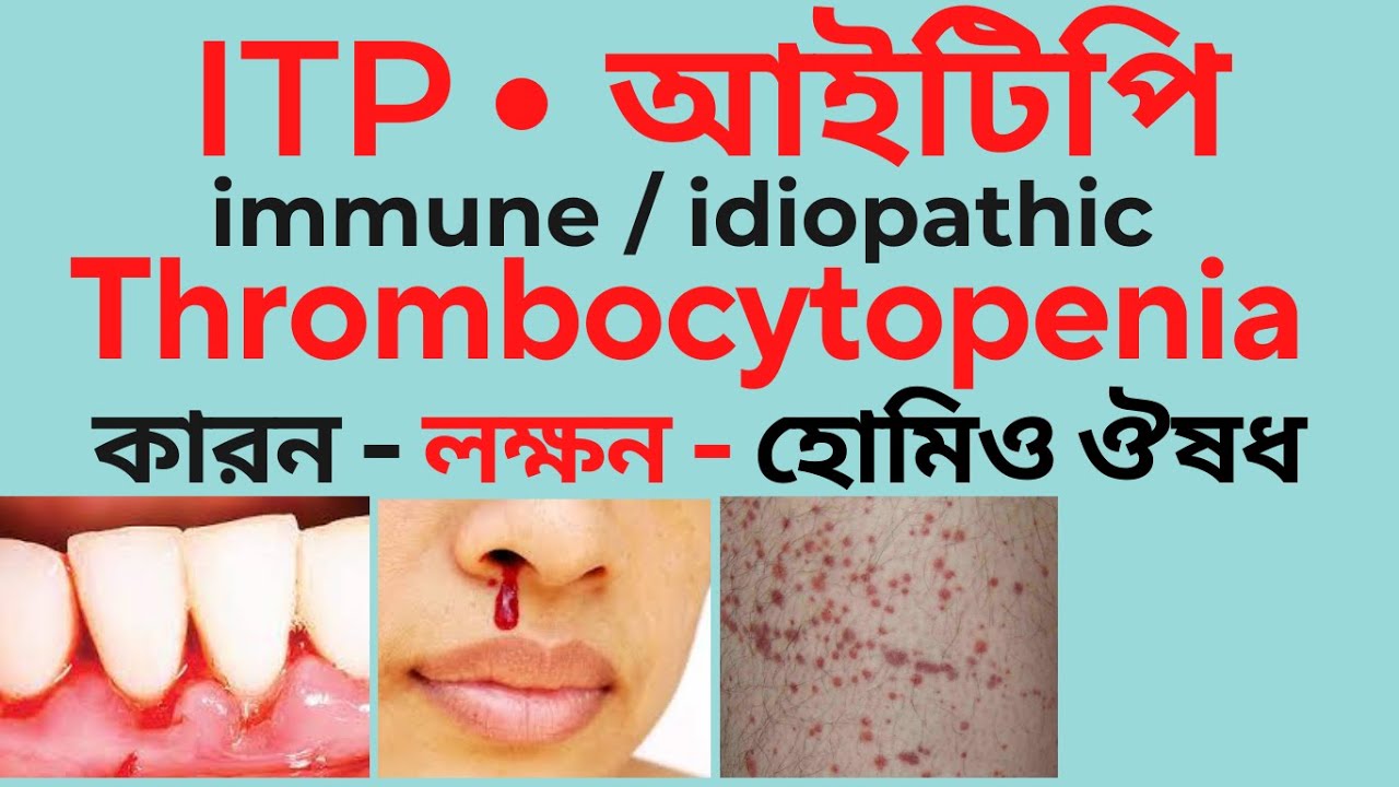 idiopathic thrombocytopenic purpura - ITP - platelet - প্লাটিলেট - Dr ...