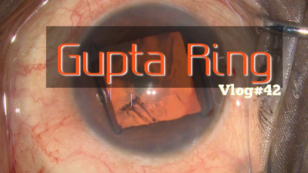 Vlg#42, Gupta pupil dilating Ring - YouTube