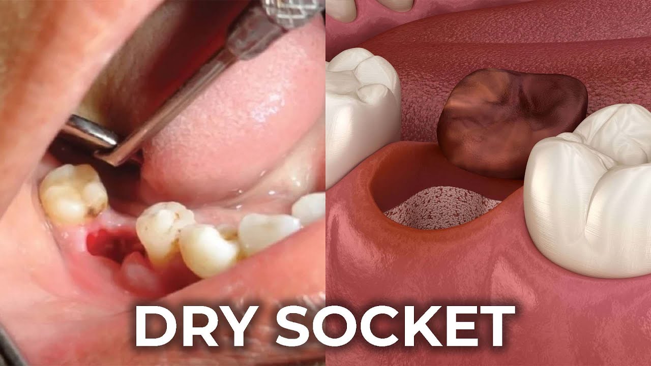 How to Treat Dry Socket After Tooth Extraction | ٹوتھ ایکسٹریکشن کے بعد ...