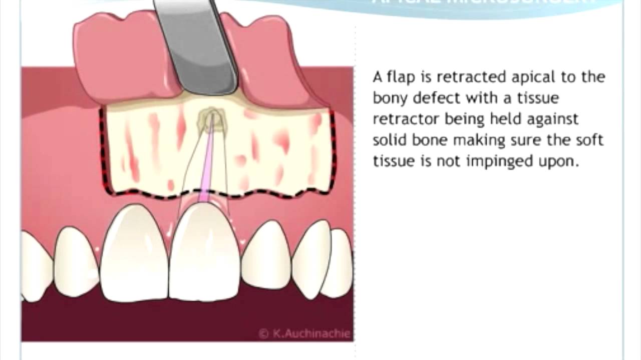 Apicectomía pasos básicos - YouTube