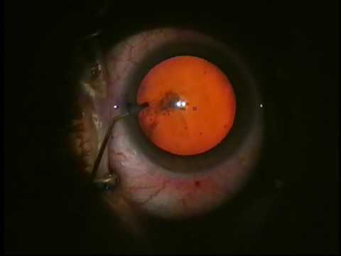 The Nine Steps of Phacoemulsification Cataract Surgery - Step 2 - YouTube