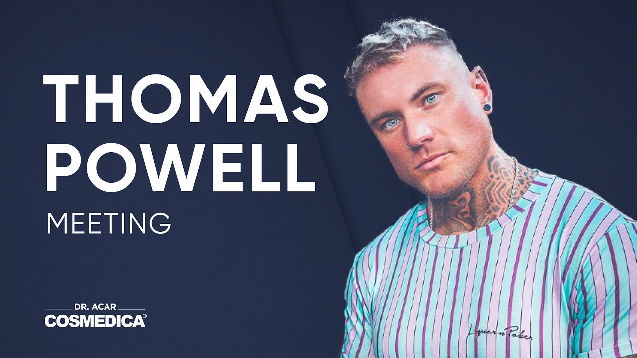 Perfect result after 10 months! How Thomas Powell chose Dr. Acar - Hair ...