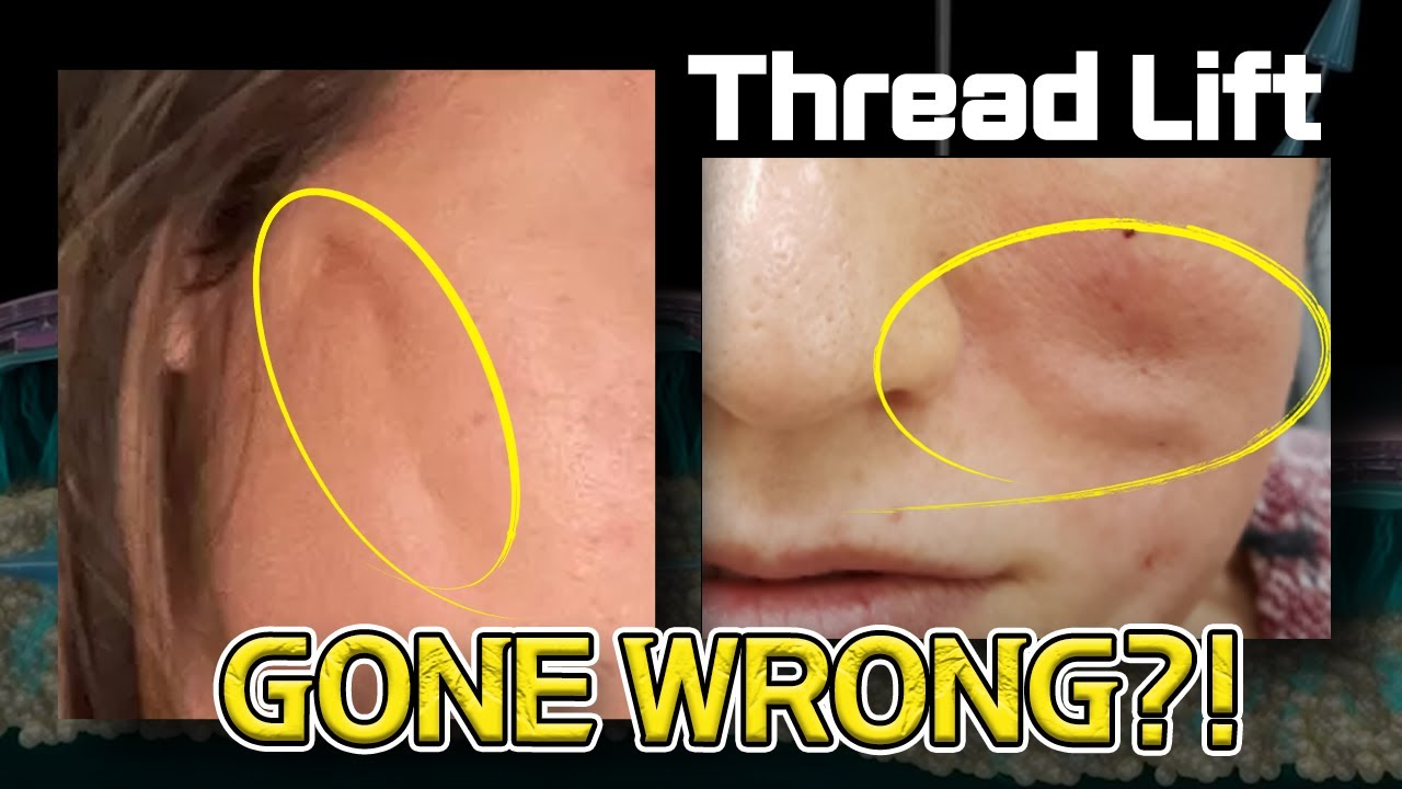Thread Lift Gone Wrong? Watch This! - YouTube