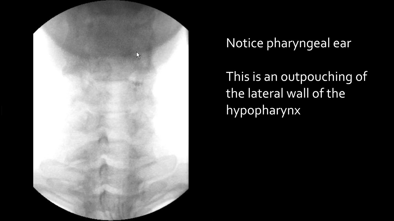 Swallowing Pharyngeal ear - YouTube