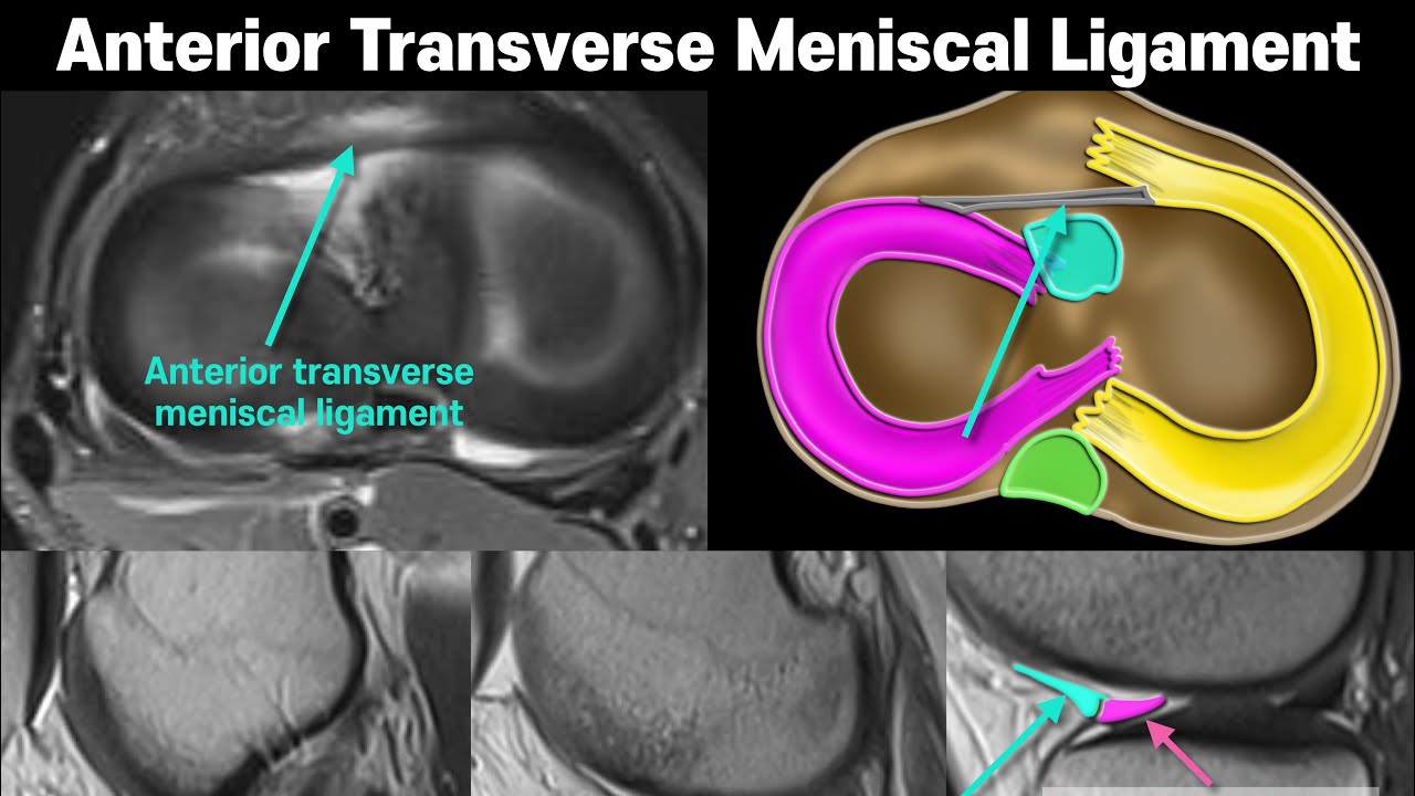 [Anatomy_26] Anterior transverse meniscal ligament -01 - YouTube