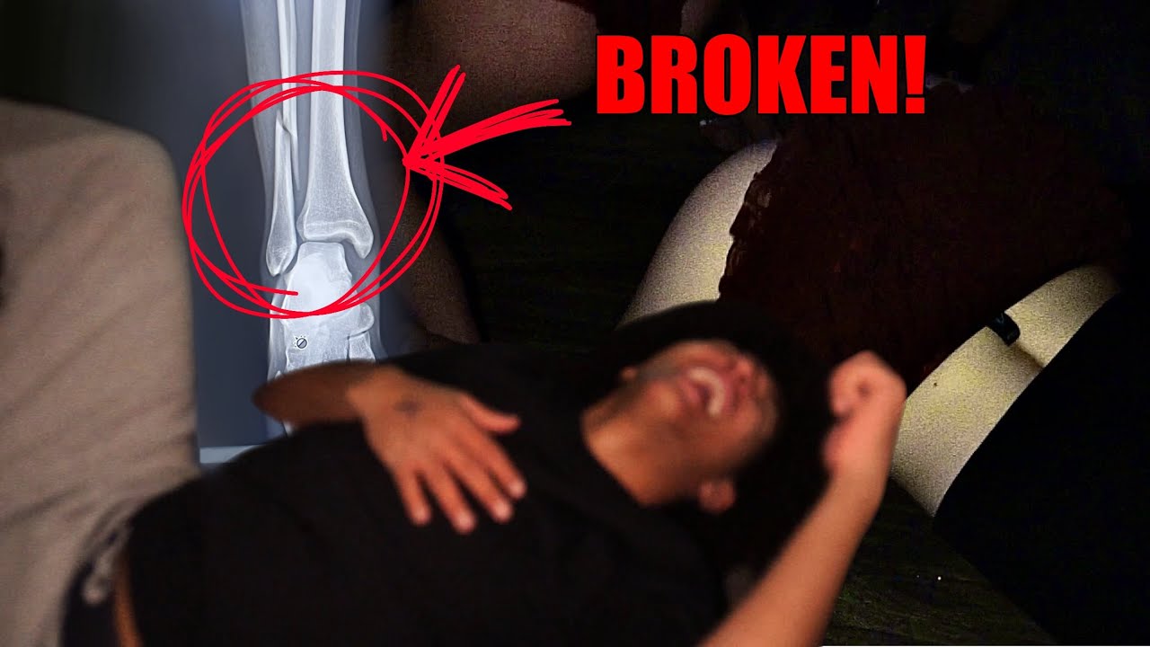 I BROKE MY LEG AT A PARTY… I NEED SURGERY🤦🏽‍♂️ - YouTube