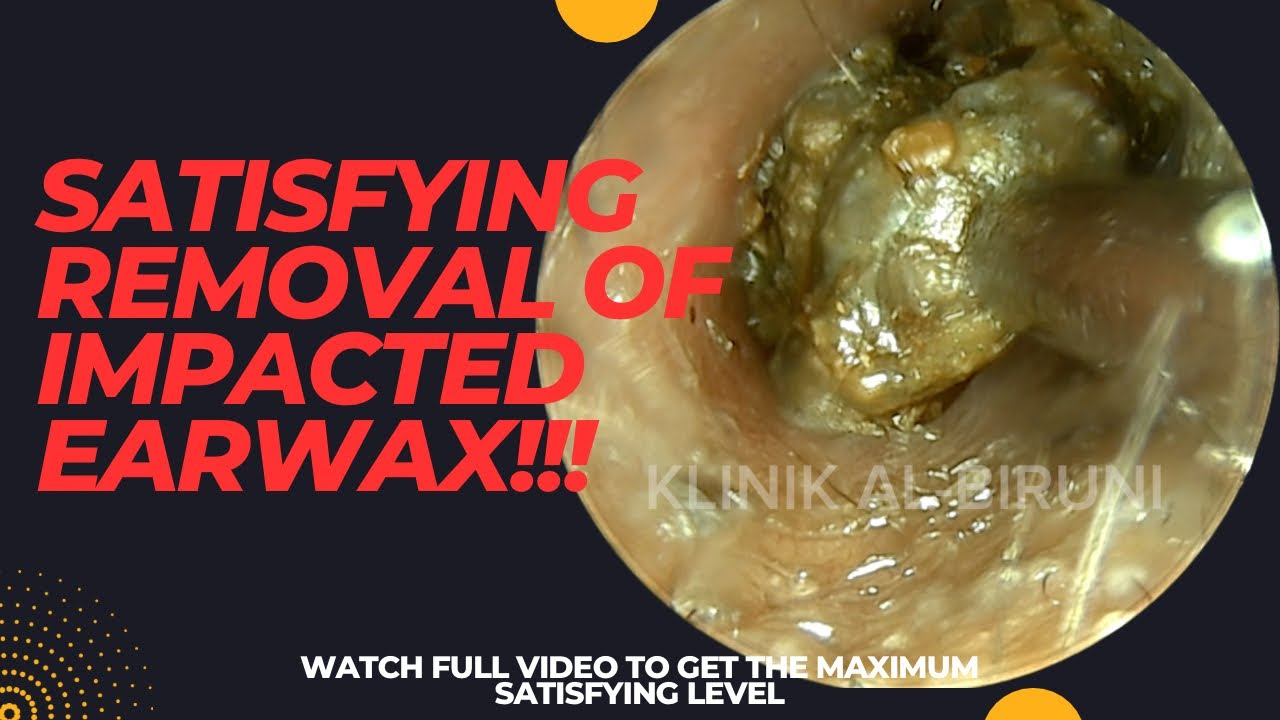 SATISFYING Impacted Earwax Removal - YouTube