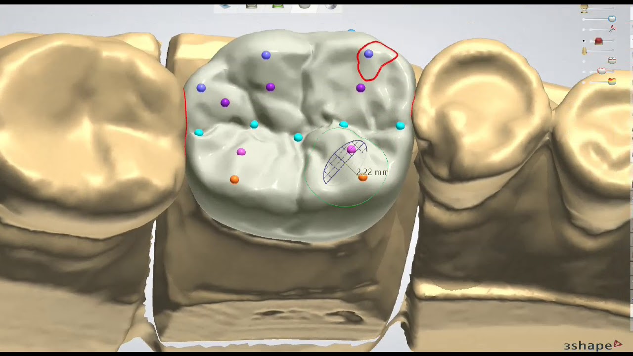 3Shape digital design - YouTube