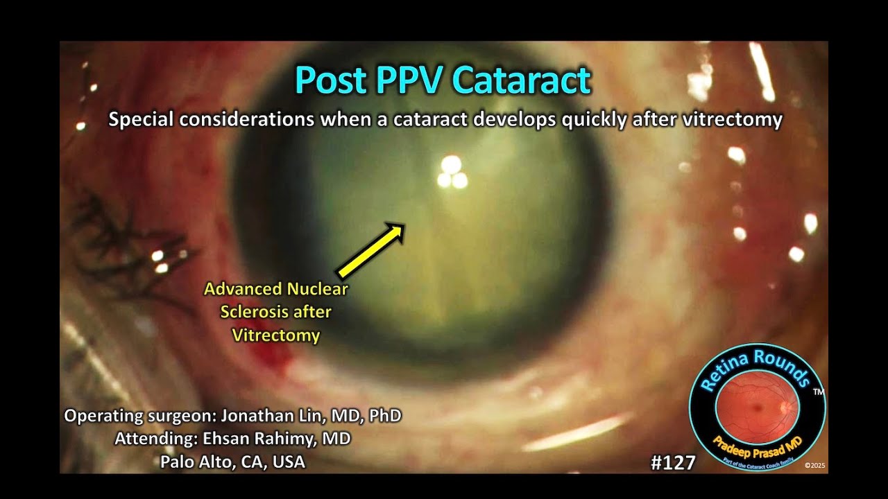 RetinaRounds™ 127: Post-PPV Cataract - YouTube