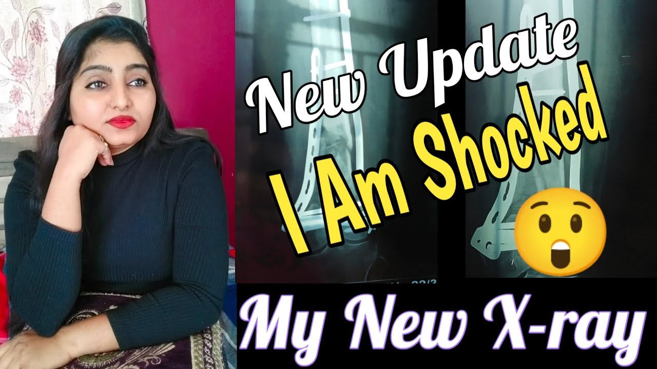 My New X- ray With New Update || My X-ray Vlogs #payallifecorner - YouTube