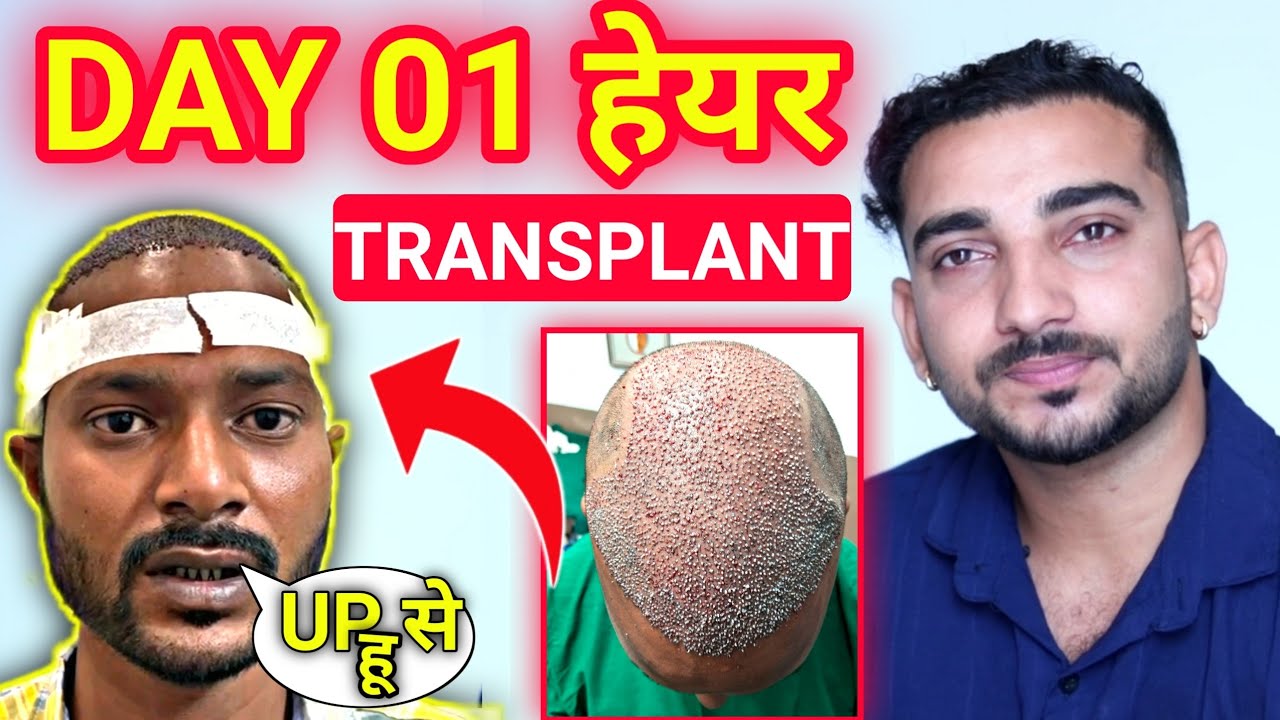 Day 01 Hair Transplant || Day One Hair Transplant Surgery | Beginning ...