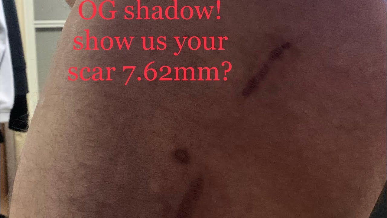 Og Shadow DON’T GOT PROOF OF WAR! The SCAR on leg from the surgery ...