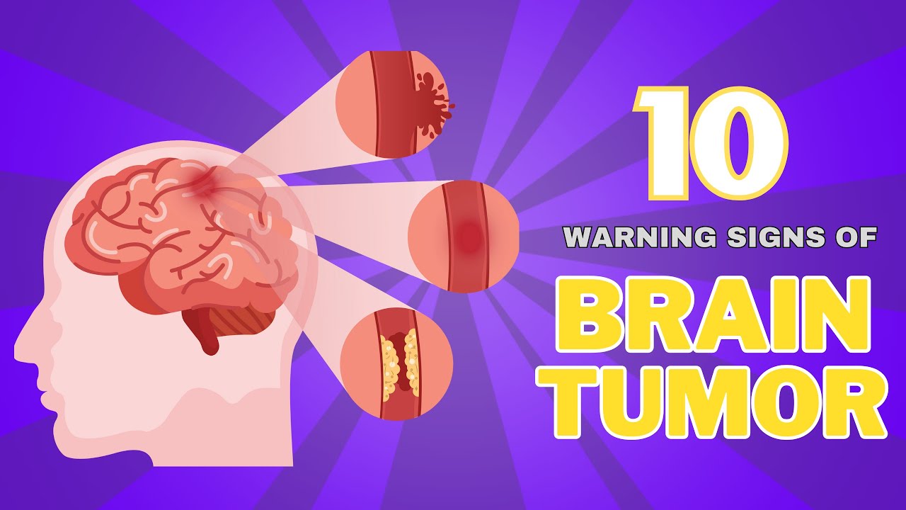 10 Warning Signs You Might Have a Brain Tumor - YouTube