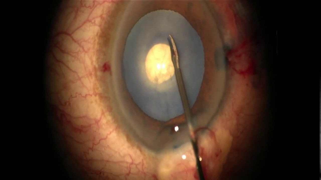 Double rhexis for white cataract - YouTube