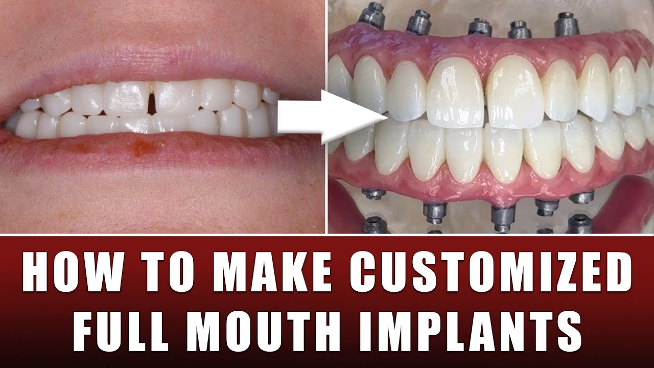 How to make Customized Full Mouth Implants - YouTube