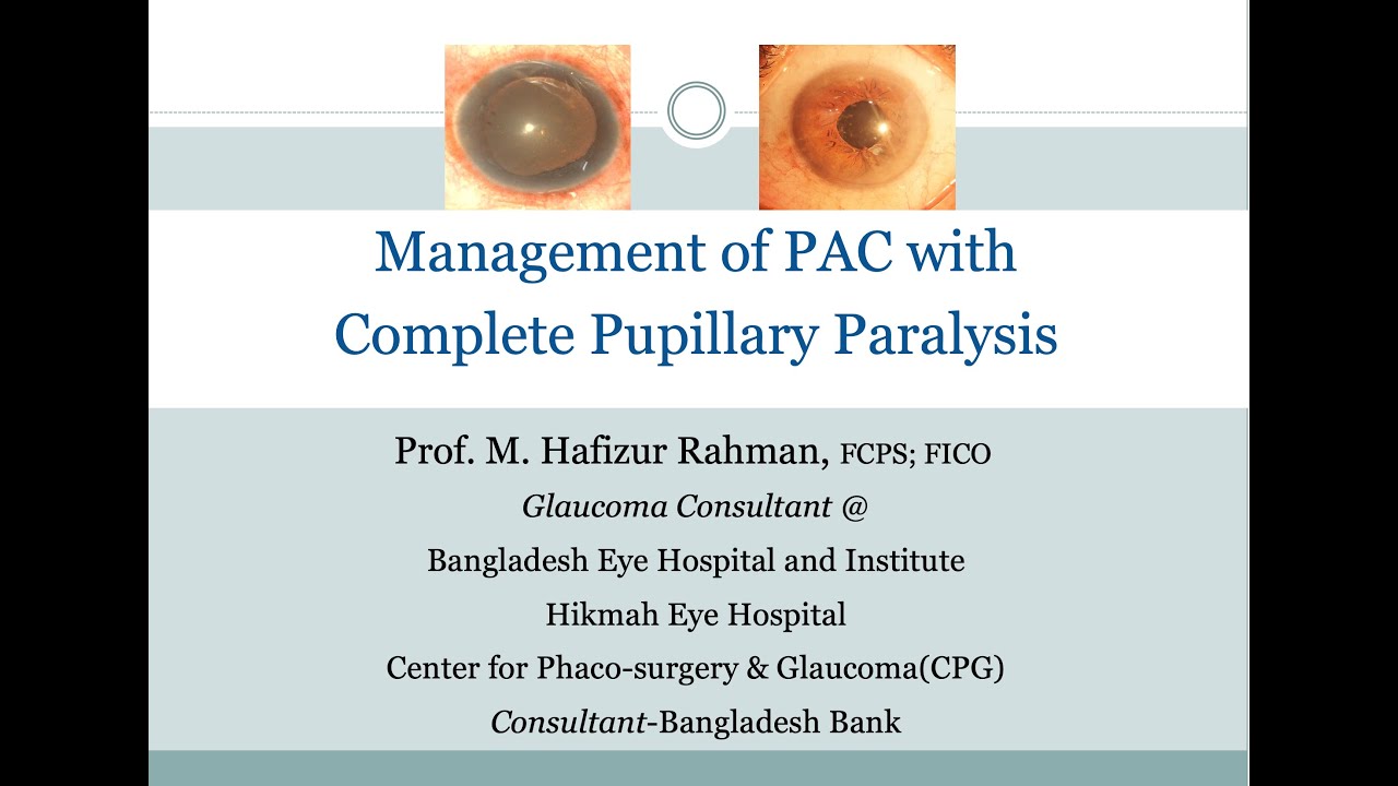Management of PAC with Complete Pupillary Paralysis - YouTube