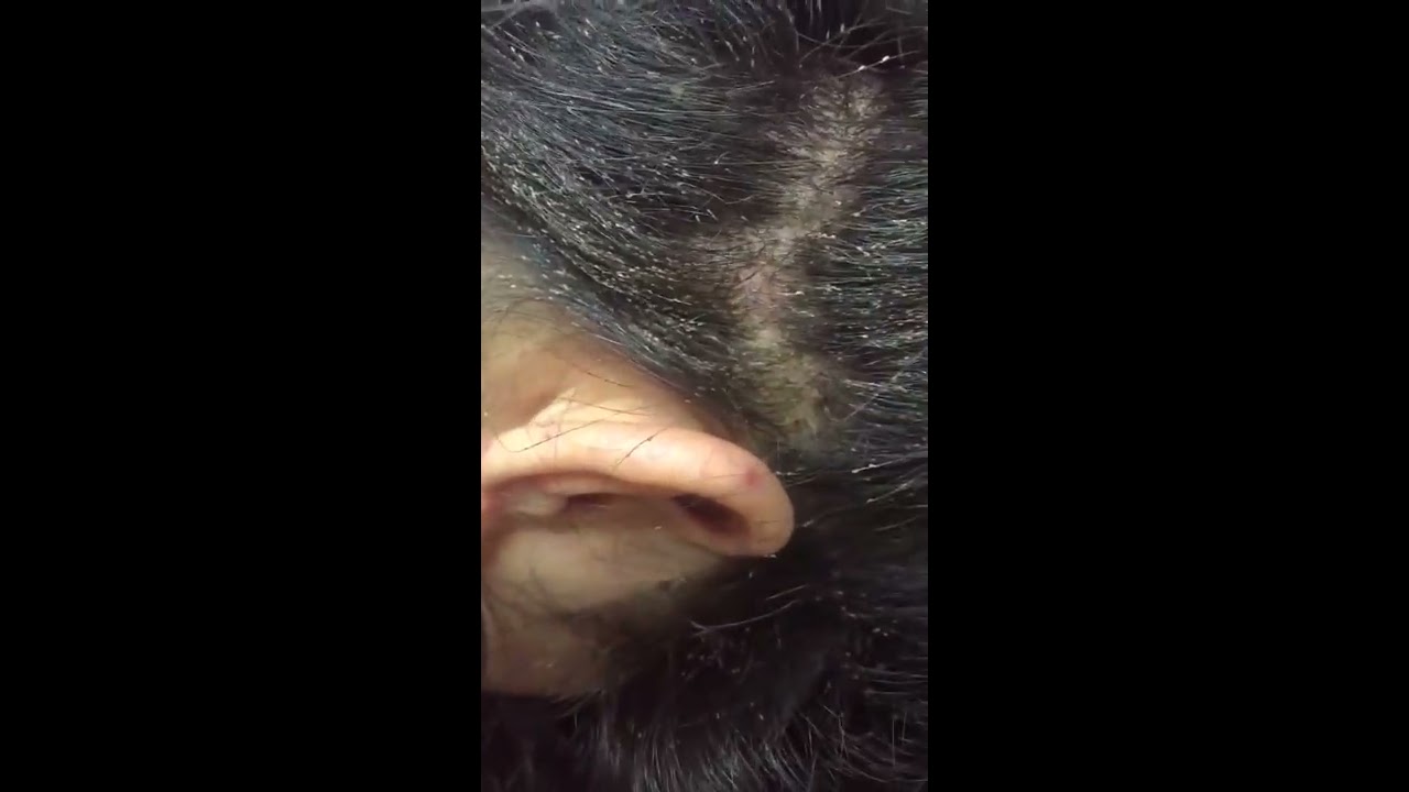 WORST LICE-INFESTED HAIR EVER ! *WARNING GROSS* - YouTube