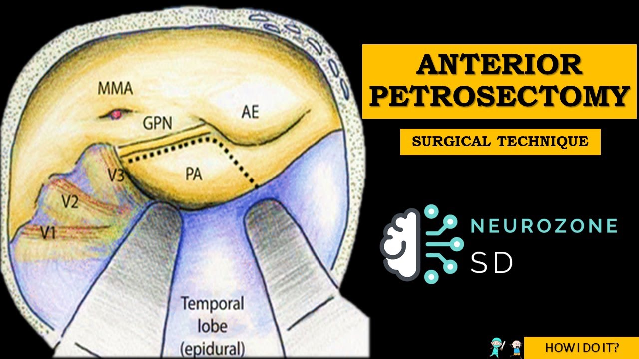 Anterior Petrosectomy - YouTube