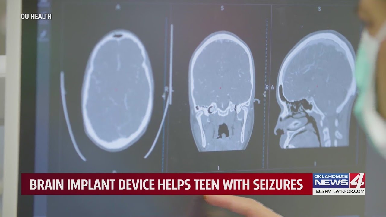 Brain implant device helps teen with seizures - YouTube