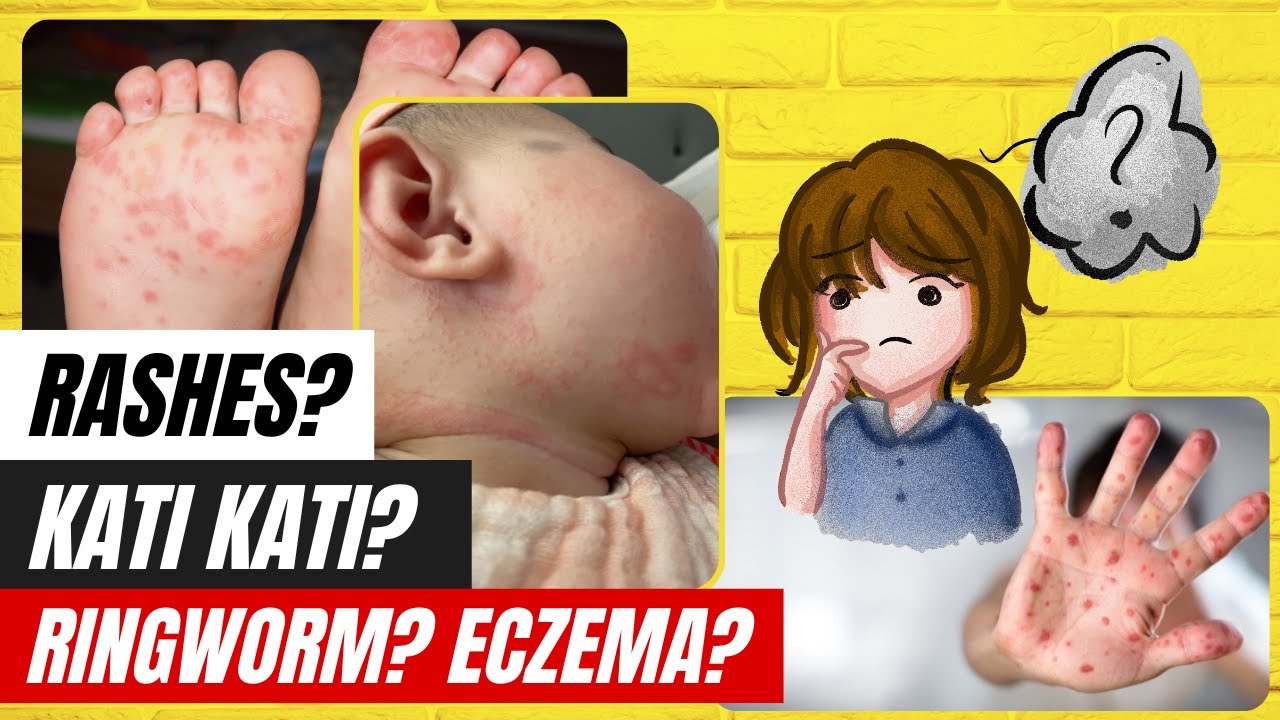 MABISANG GAMOT SA KATIKATI, RASHES, AT PEKLAT SA BALAT NG BATA | PAANO ...