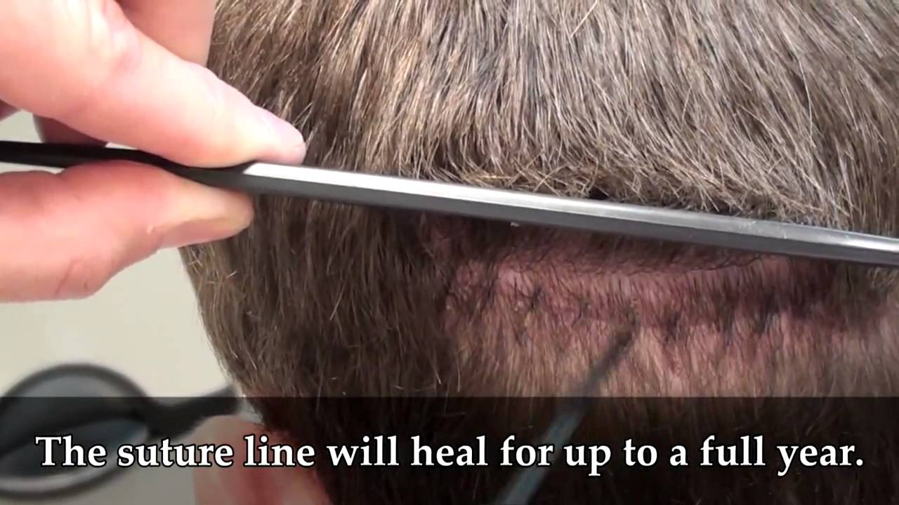 GreatHairTransplant no scar hair transplant at suture removal 10 days ...