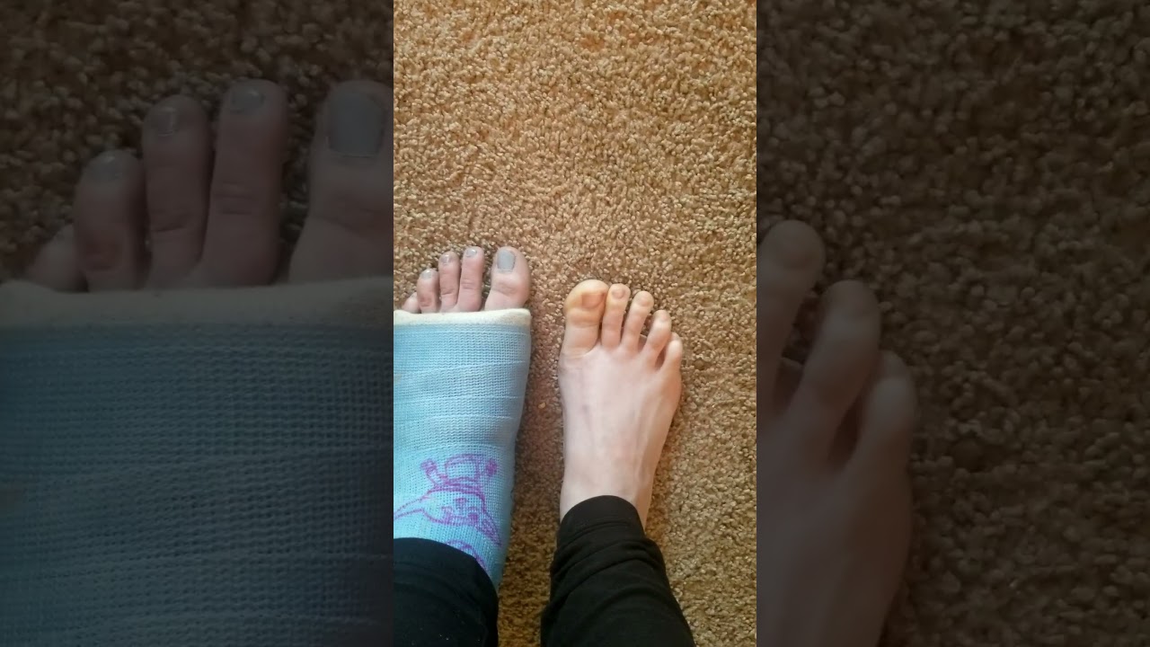 ASMR Requested Wiggling My Toes In My Foot Cast #shorts - YouTube