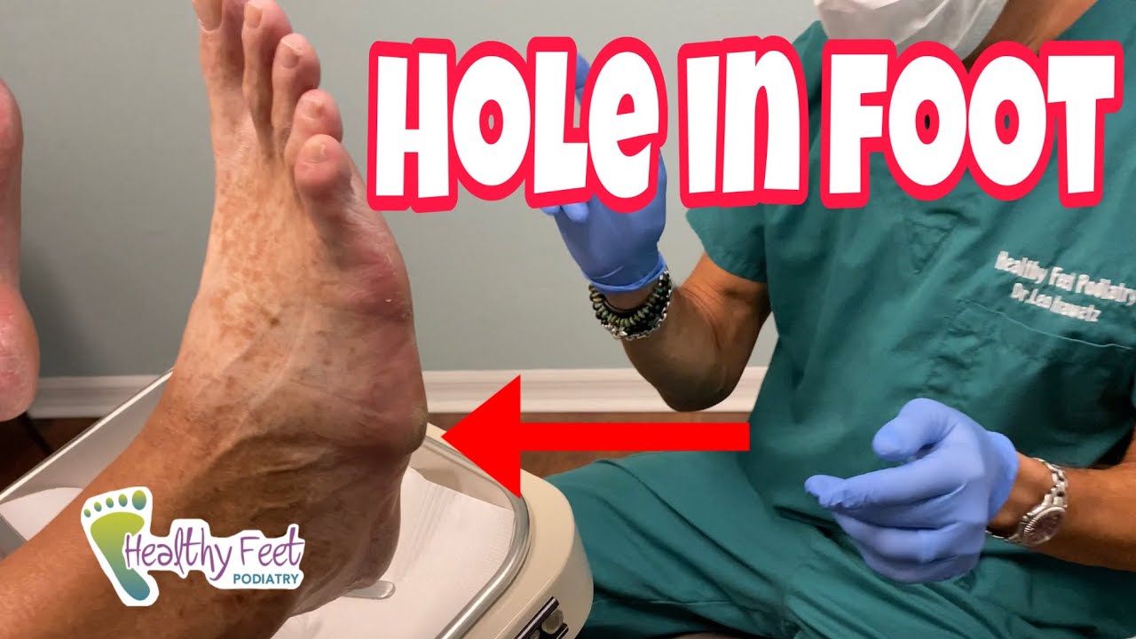 Another Diabetic Foot Catastrophe And Bonus Diabetic Foot Care Tips Youtube