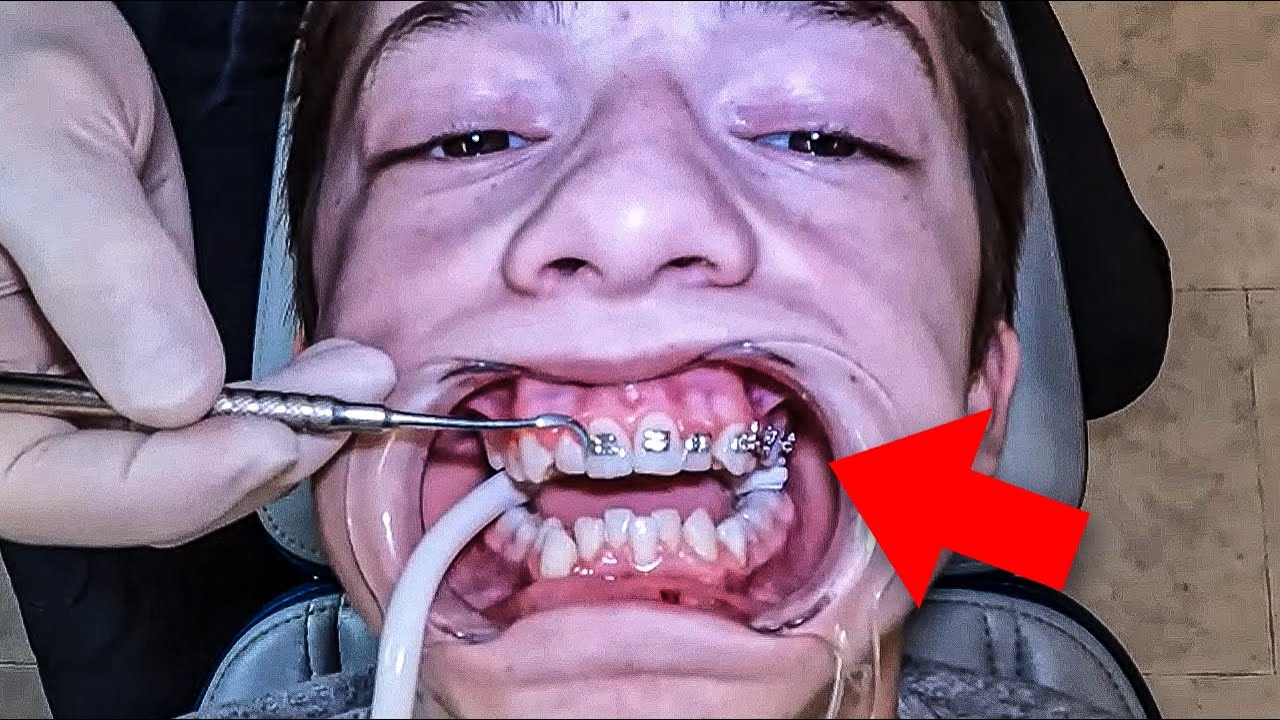 Getting Braces On to Fix a DEEP BITE!!...full process - YouTube