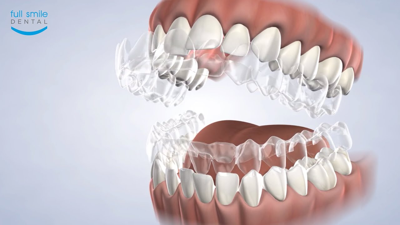 Retainer Designs Like Brace Price
