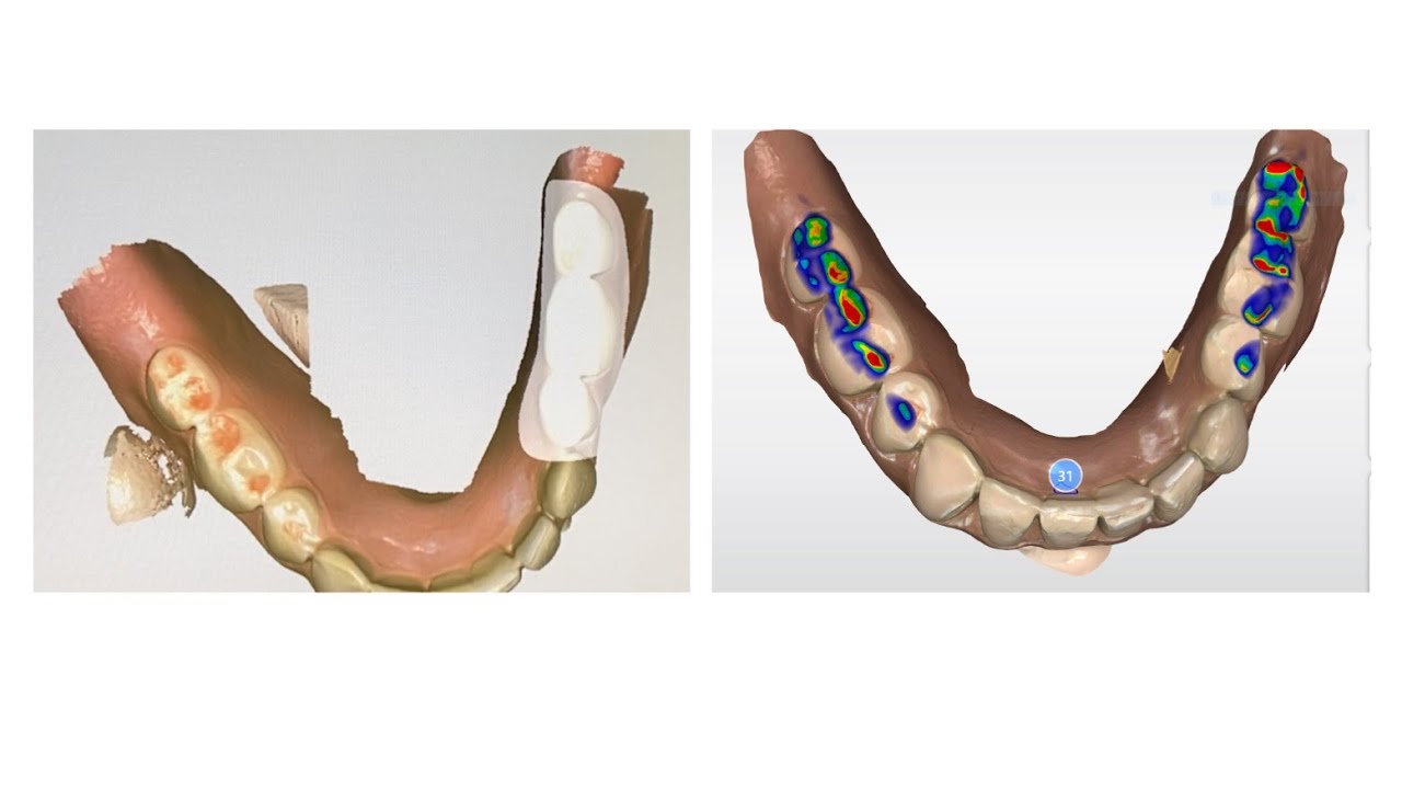 Virtual Mount - A New Digital Technique for Occlusal Examination ...