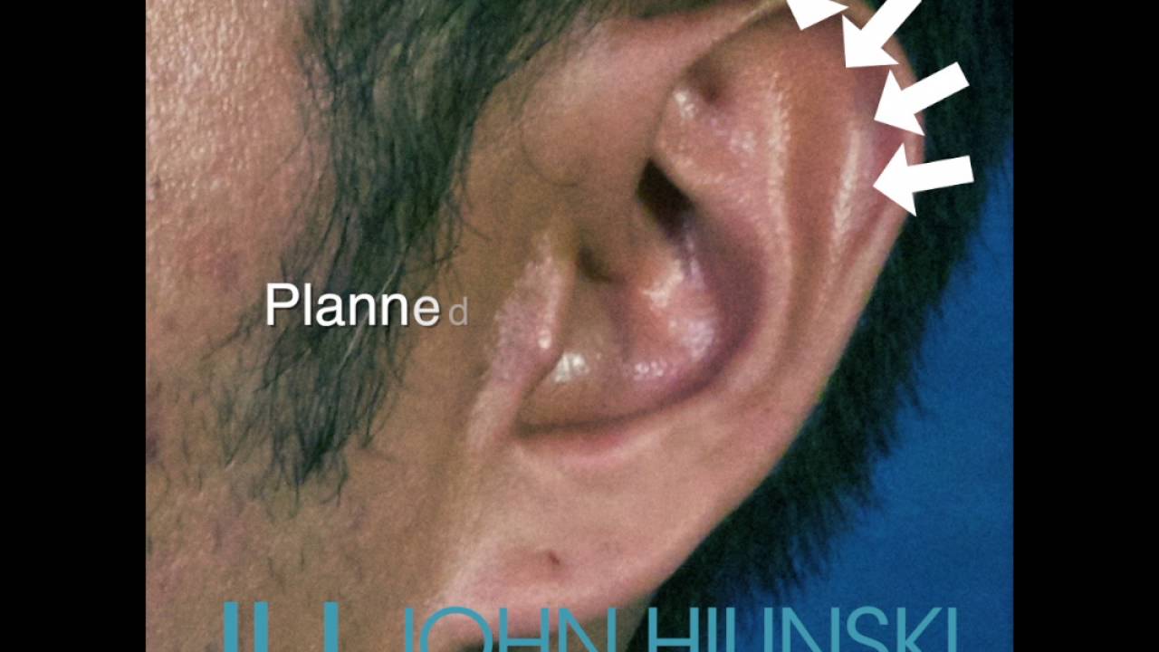 Scapha Reduction Bilaterally - YouTube