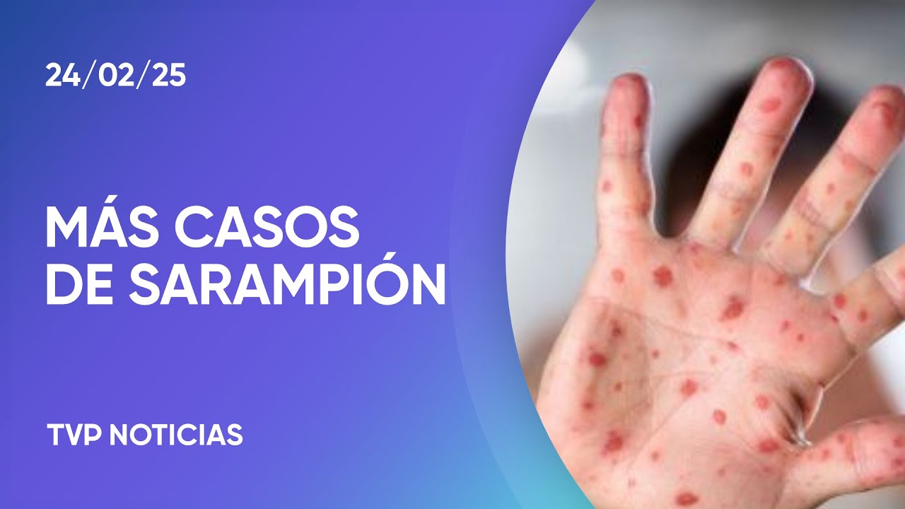 Confirmaron el cuarto caso de sarampión en CABA - YouTube