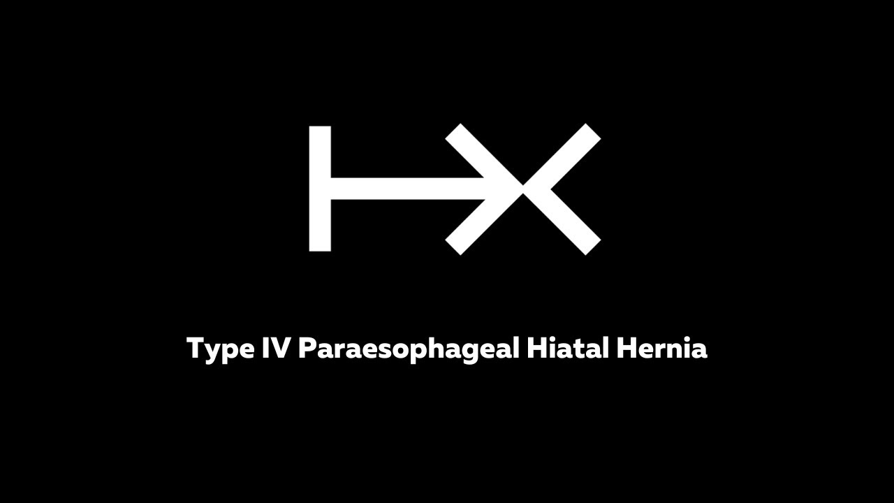 Type IV Paraesophageal Hiatal Hernia with HandX™ | Human Xtensions ...