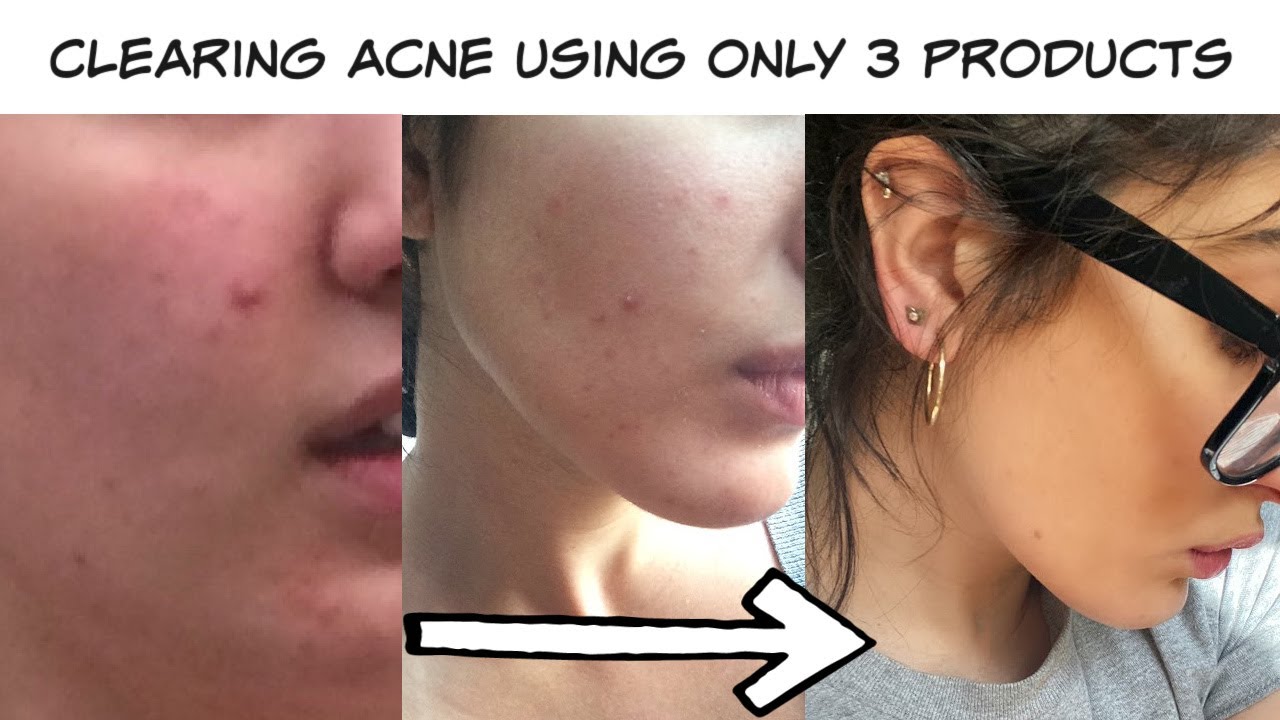 How I Cleared My Hormonal Adult Acne Using Only 3 Affordable Products I