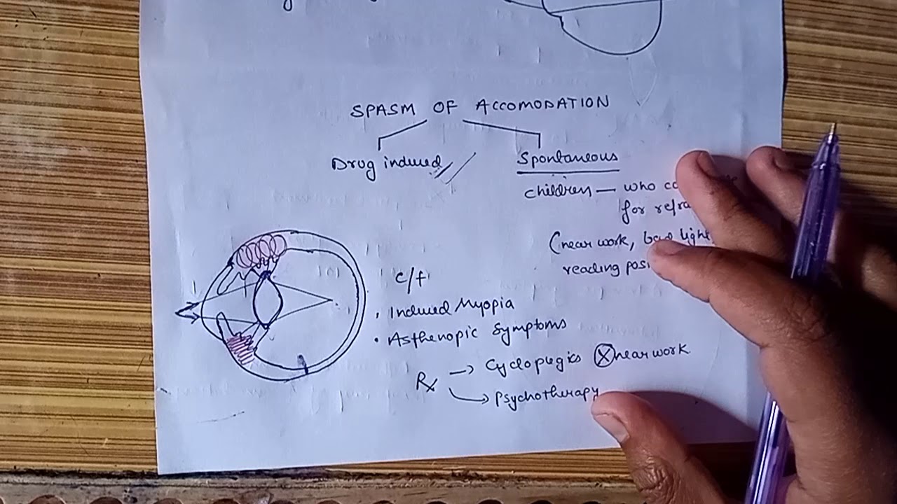 SPASM OF ACCOMODATION - YouTube