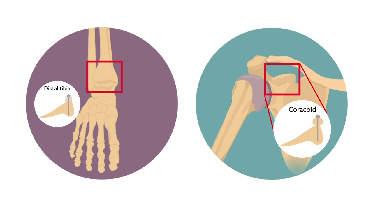 Distal tibial allografts are a promising option for treating anterior ...