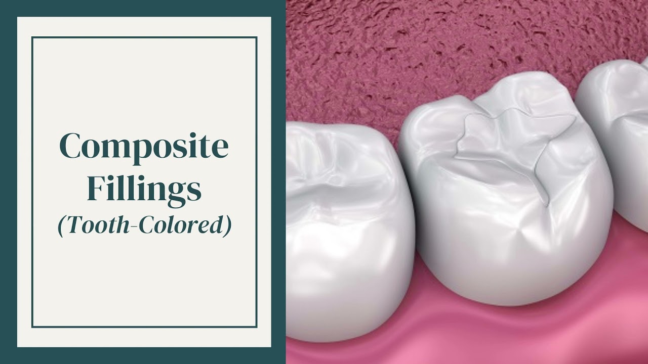 5 Types of Dental Fillings - YouTube