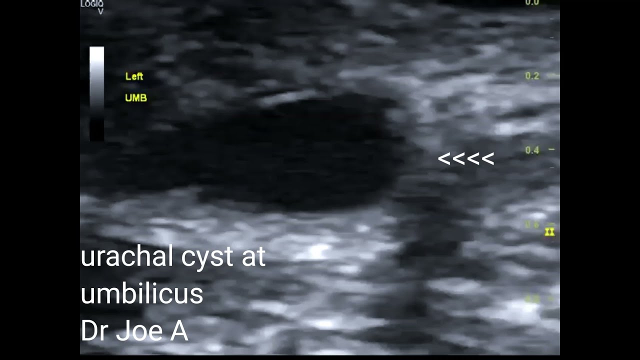 Urachal cyst at umbilicus adult female ultrasound video - YouTube