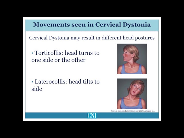 Cervical Dystonia Pain