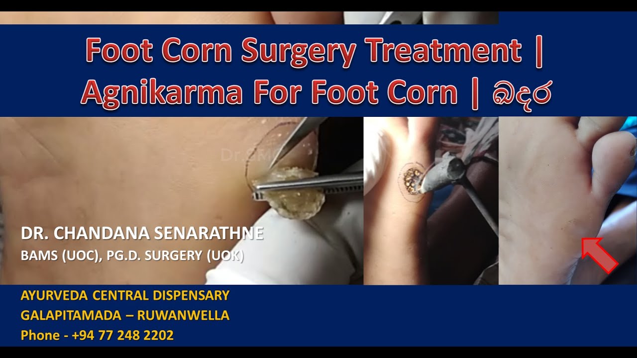 Foot Corn Surgery Treatment | Agnikarma for Foot Corn | Kadara | Heloma ...