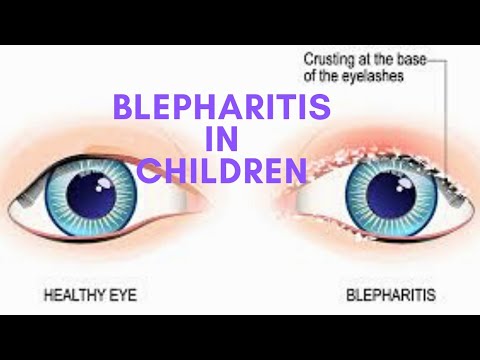Blepharitis in children - YouTube