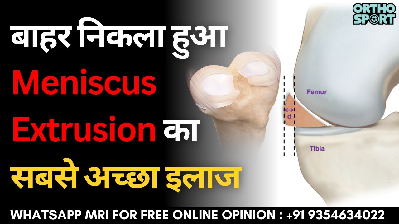 Meniscus बाहर निकला हुआ है तो क्या करें ? सबसे अच्छा इलाज ! Meniscus ...