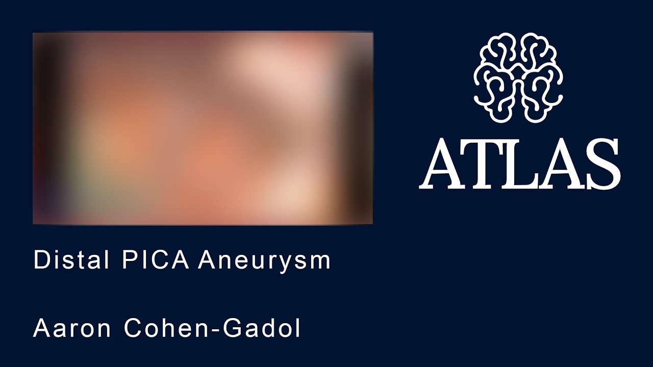 Distal PICA Aneurysm by Dr. Aaron Cohen-Gadol - YouTube