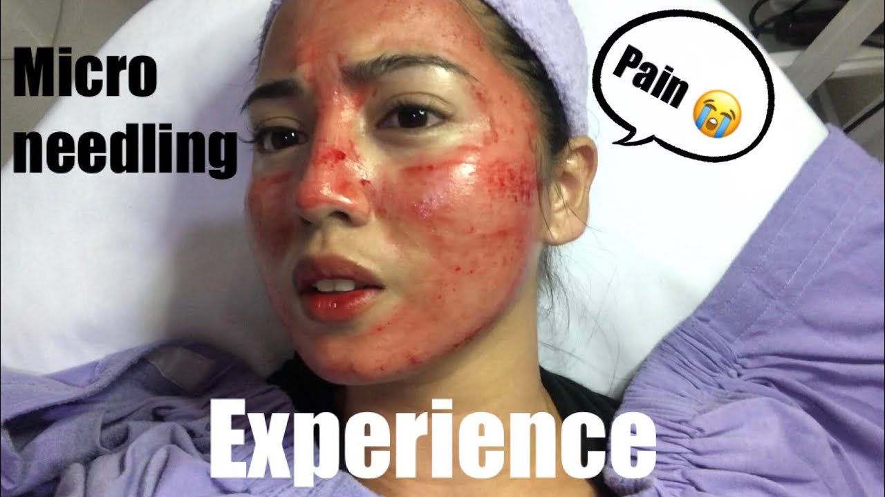 Collagenesis Microneedling Experience 💗 - YouTube