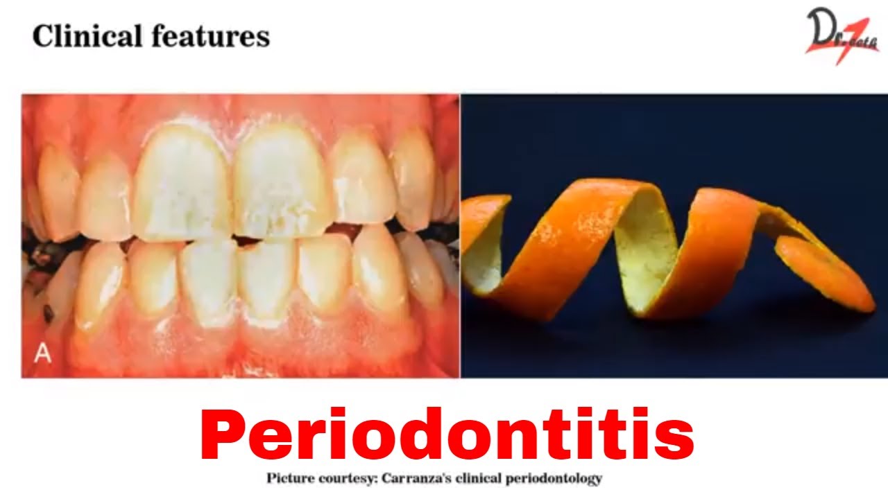 Chronic periodontitis - YouTube